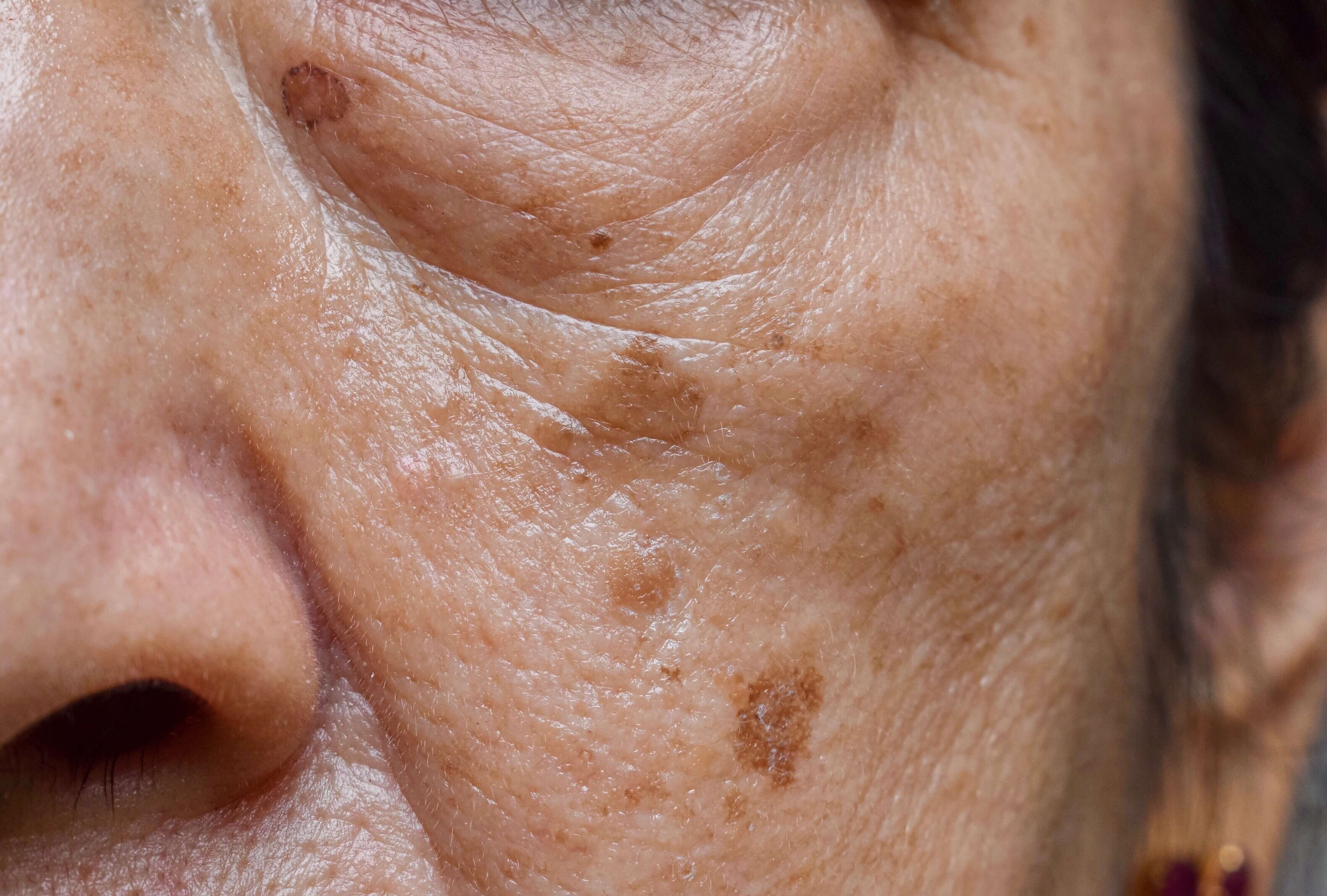 Wrinkles and Sun Damage in Katy, TX | About Face & Body